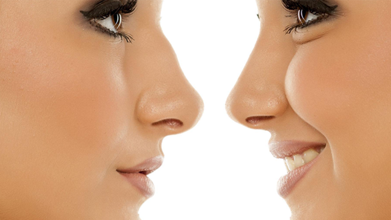 Injection d’acide hyaluronique nez : une rhinoplastie médicale ...